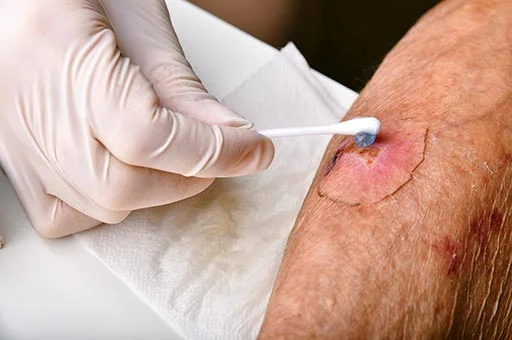 Vascular Wound Treatment Need Chronic Wound Care? How Vascular And